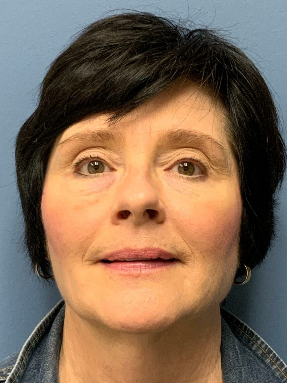 Facial Surgeries - Bellevue & Kirkland, WA Plastic Surgeon